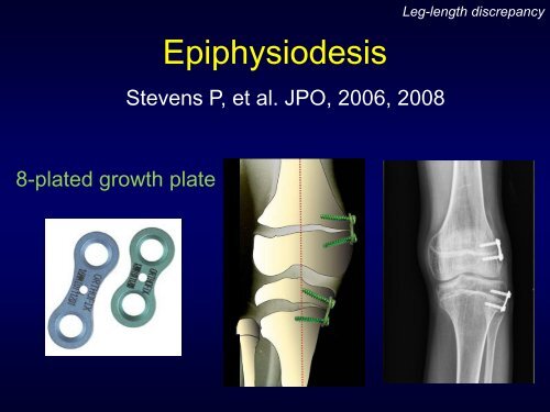 Epiphysiodesis • PETS(P