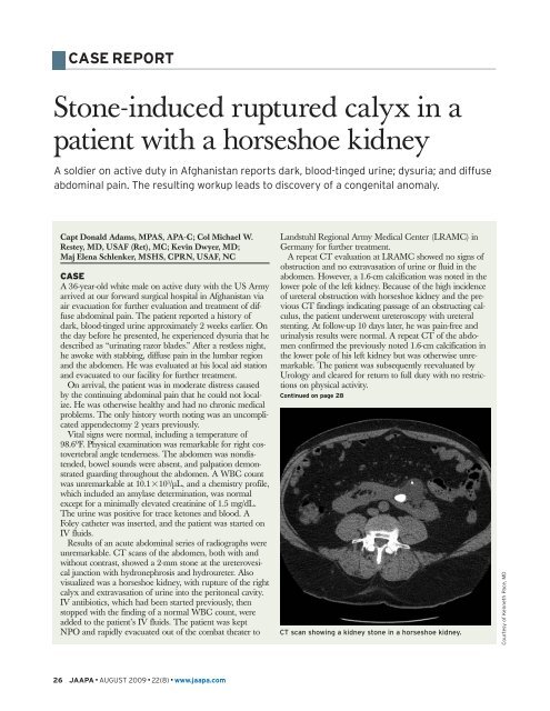 Stone-induced Ruptured Calyx In A Patient With - Haymarket Media ...