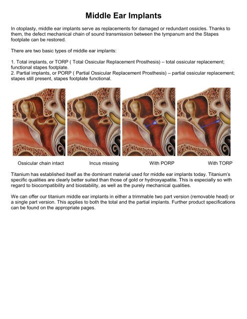 Sizers for Middle Ear Implants