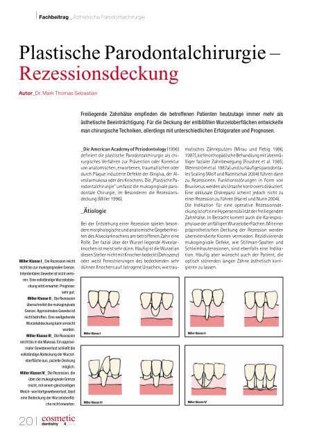 Plastische Parodontalchirurgie – Rezessionsdeckung