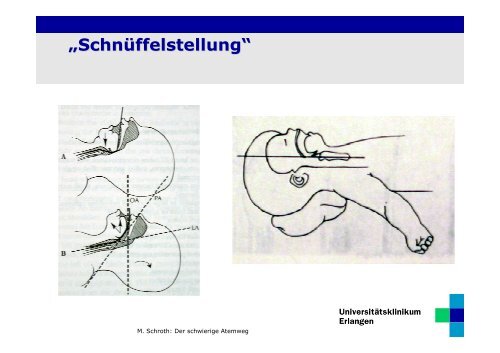 Schwierige Intubation ohn