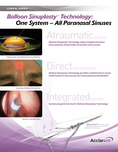 Balloon Sinuplasty Technology
