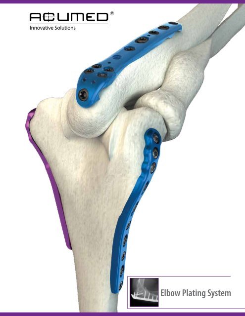 Elbow Plating System Brochure and Surgical Technique