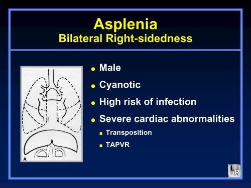 Asplenia Bilateral Right-