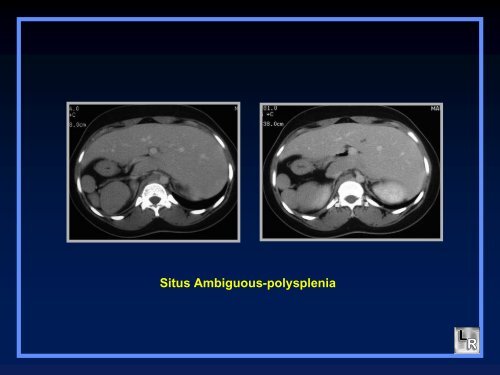 Asplenia/Polysplenia Asp