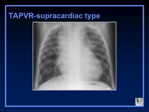TAPVR-supracardiac