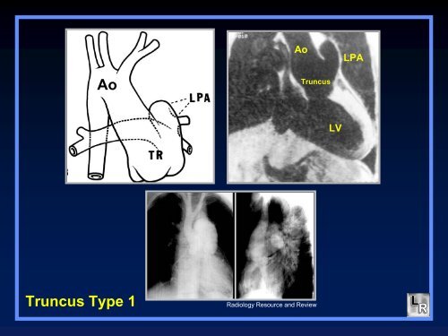 Truncus arteriosus-Type 1