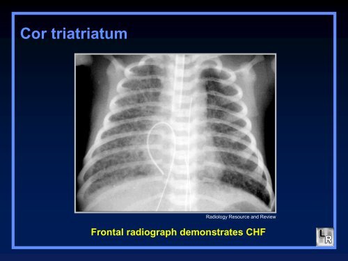 Cor triatriatum Radiology
