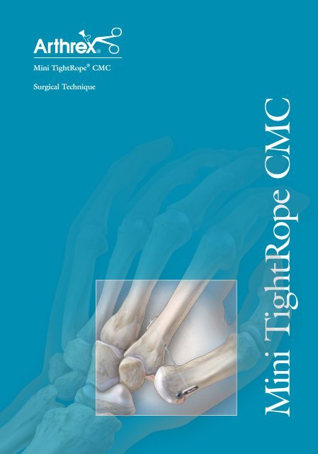 Mini TightRope® CMC Fixation - Arthrex