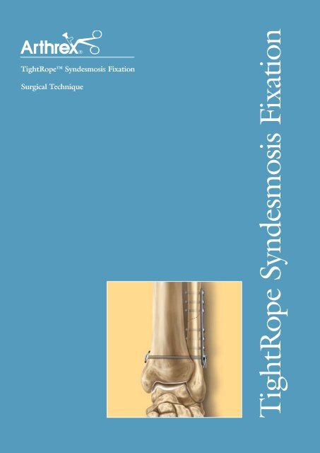 TightRope™ Syndesmosis Fixation - DrStorm