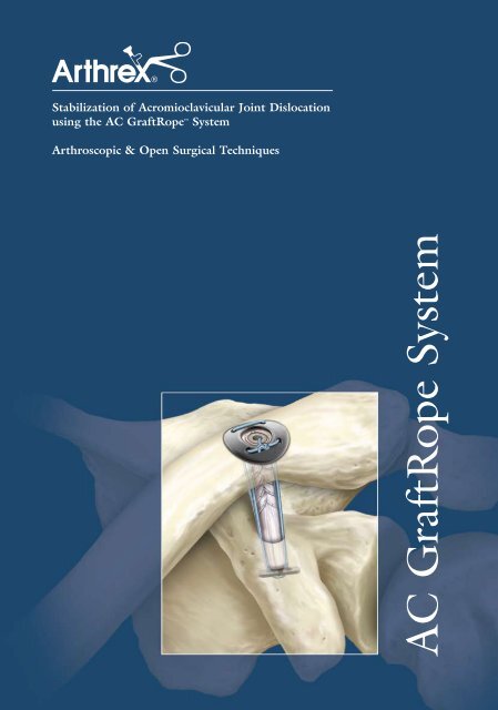 AC GraftRope System - Ankle Tightrope Syndesmosis fixation