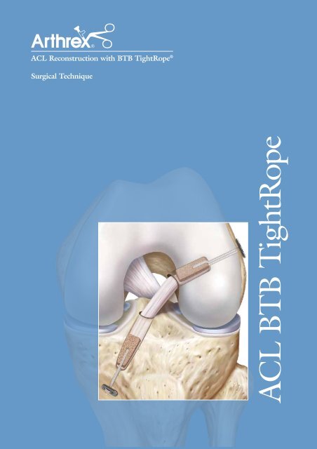 ACL Reconstruction with BTB TightRope® - Ramsay Medical