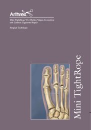 Mini TightRope® CMC - Ankle Tightrope Syndesmosis fixation