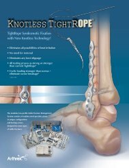 Mini TightRope® CMC Fixation - Arthrex