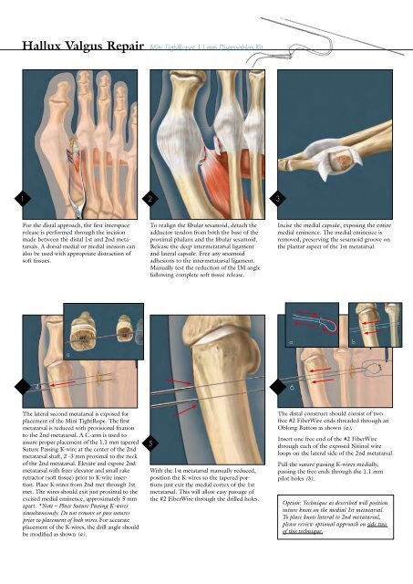 The Mini TightRope System