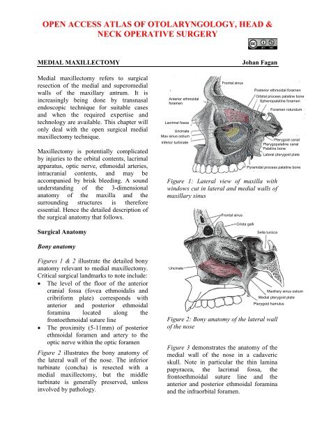 Medial maxillectomy - Vula - University of Cape Town