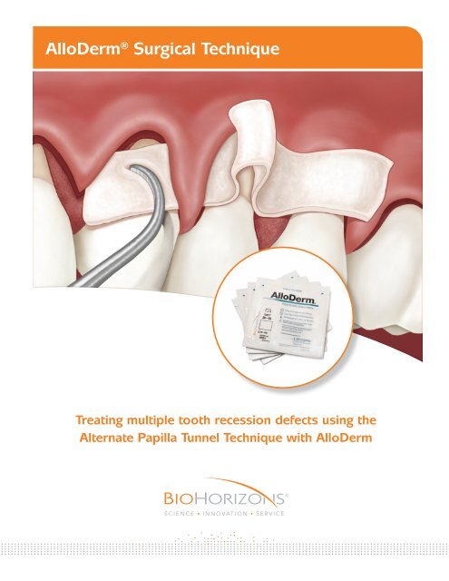 AlloDerm® Surgical Technique - BioHorizons