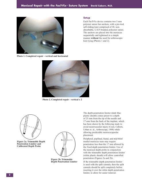2 Meniscal
