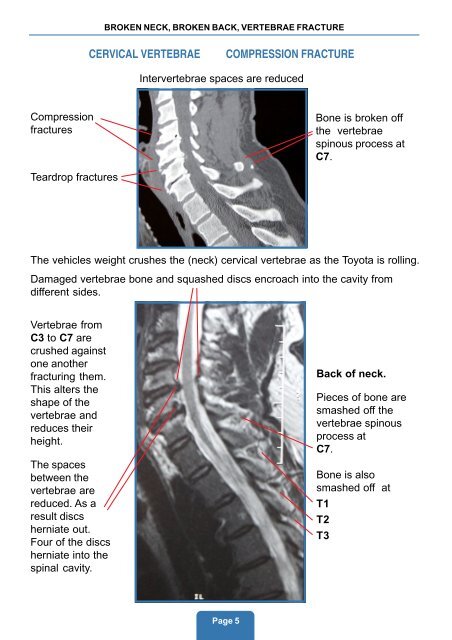 BROKEN NECK, BROKEN BACK,