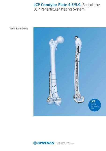 LCP Condylar Plate 4.5/5.0. Part of the LCP Periarticular ... - Synthes