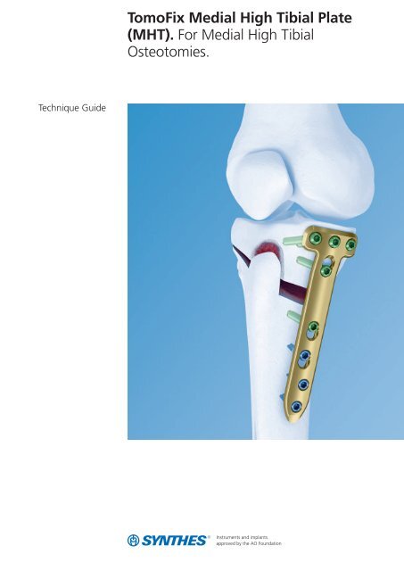 TomoFix Medial High Tibial Plate - Synthes