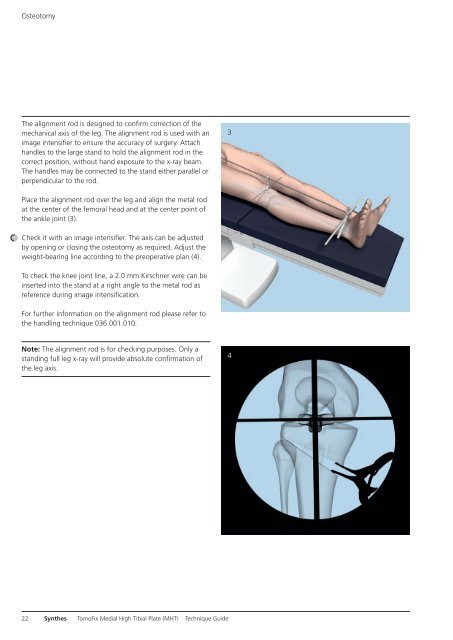 Osteotomy The alignment r