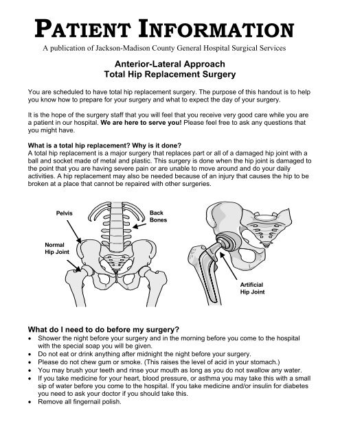 What Is A Lateral Total Hip Replacement - Infoupdate.org What Is A Lateral Total Hip Replacement - Infoupdate.org