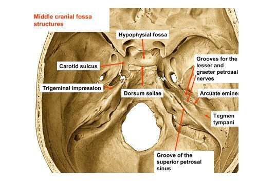 Middle cranial fossa stru