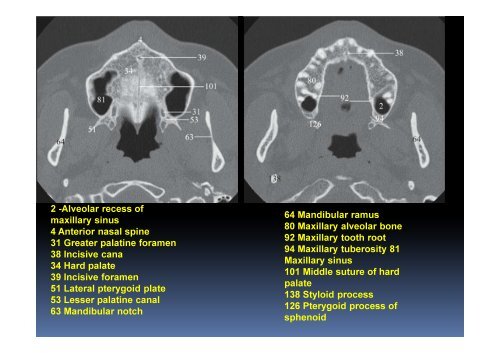 2 -Alveolar recess of max
