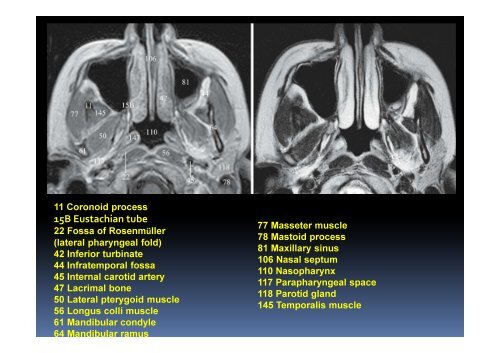 1 Adenoidal tissue (nasop