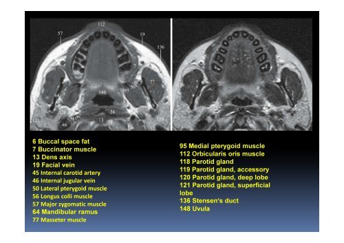 6 Buccal space fat 7 Bucc