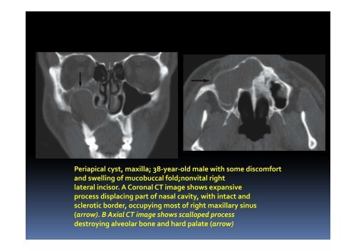 Periapical cyst, maxilla;