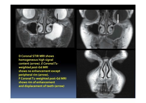 B Coronal CT