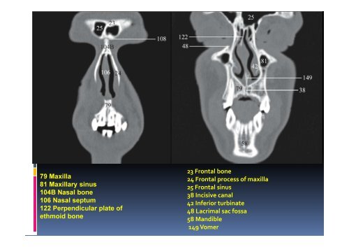 79 Maxilla 81 Maxillary s