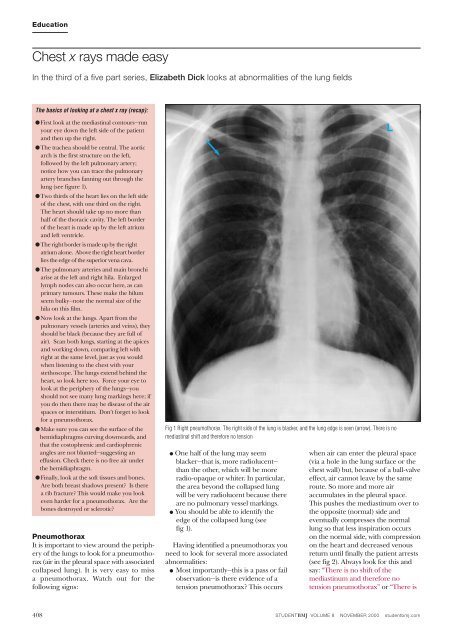 Part 3 Chest x rays made easy abnormalities