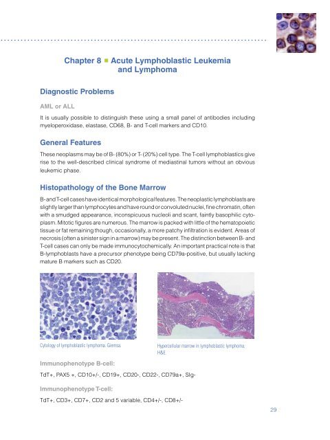 Acute Lymphoblastic Lymphoma Leukemia