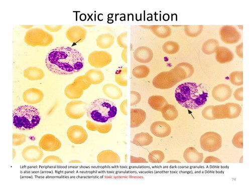 Toxic granulation • Lef