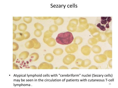Sezary cells • Atypical