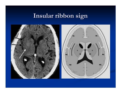 Insular ribbon