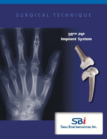 PIP Joint Arthroplasty Using SBi SR™ PIP Implant System