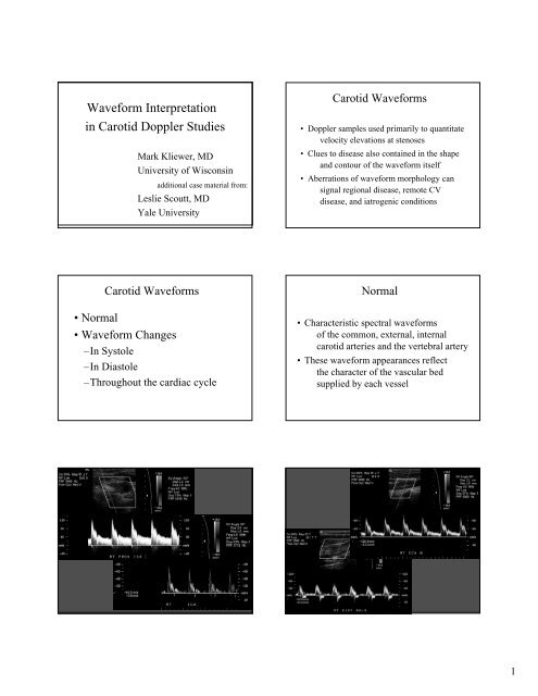 Waveform Interpretation in Carotid Doppler Studies