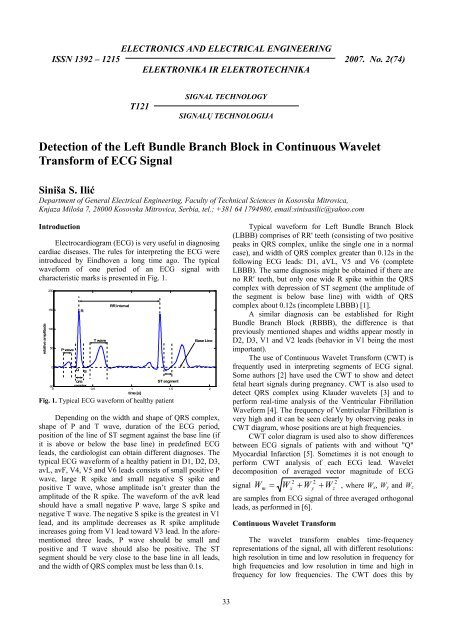 Detection Of The Left Bundle Branch Block In Electronics And