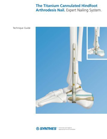 The Titanium Cannulated Retrograde/Antegrade Femoral Nail TG