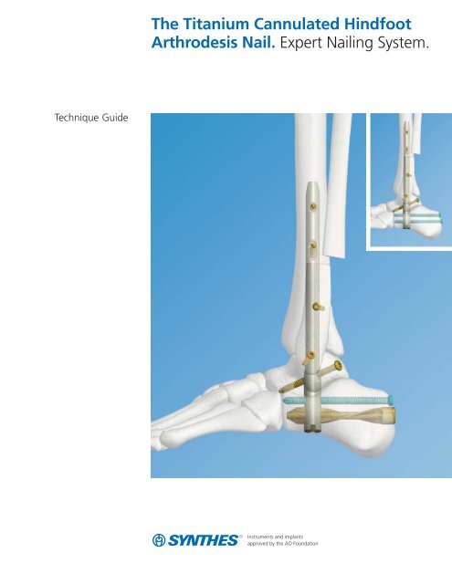 The Titanium Cannulated Hindfoot Arthrodesis Nail TG - Synthes