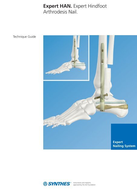 Expert HAN. Expert Hindfoot Arthrodesis Nail. - Synthes