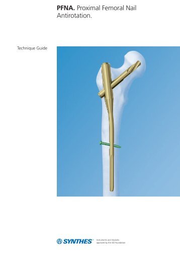 Expert R/AFN. Clavo femoral retrógrado /anterógrado. - Synthes