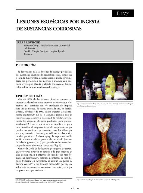 Lesiones esofágicas por ingestas de sustancias corrosivas.