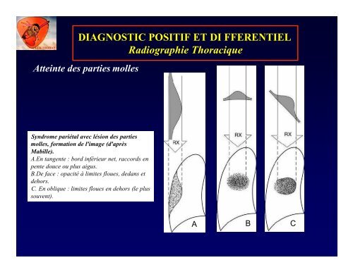 Syndrome pariétal avec l