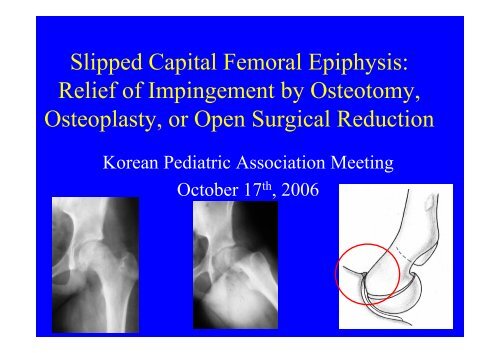 Slipped Capital Femoral Epiphysis: Relief of Impingement by ...