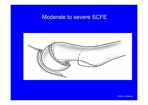 Moderate to severe SCFE O